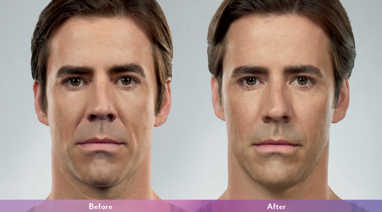 Dermal Fillers for Men in Ann Arbor, MI | Center for Plastic Surgery ...
