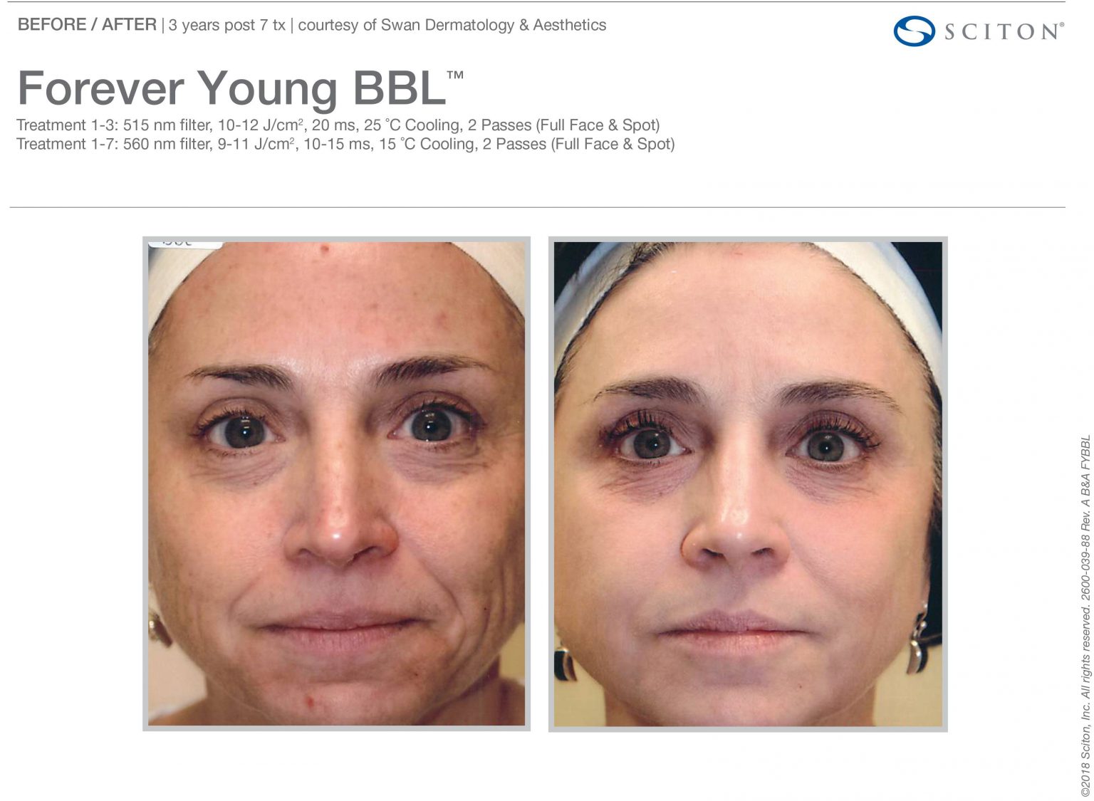 IPL (BBL™, Forever Young BBL™, & Forever Clear BBL™) in Ann Arbor, MI ...