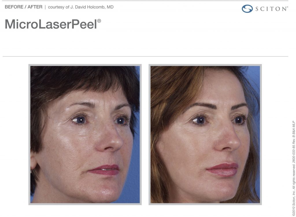 Laser Skin Resurfacing in Ann Arbor, MI | Center for Plastic Surgery ...