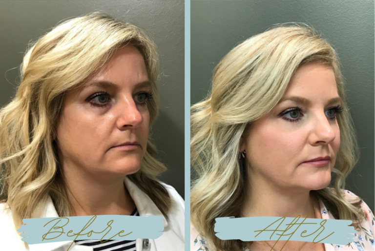 Two Facelift Approaches: Michelle’s Injectable Full Face Correction vs ...