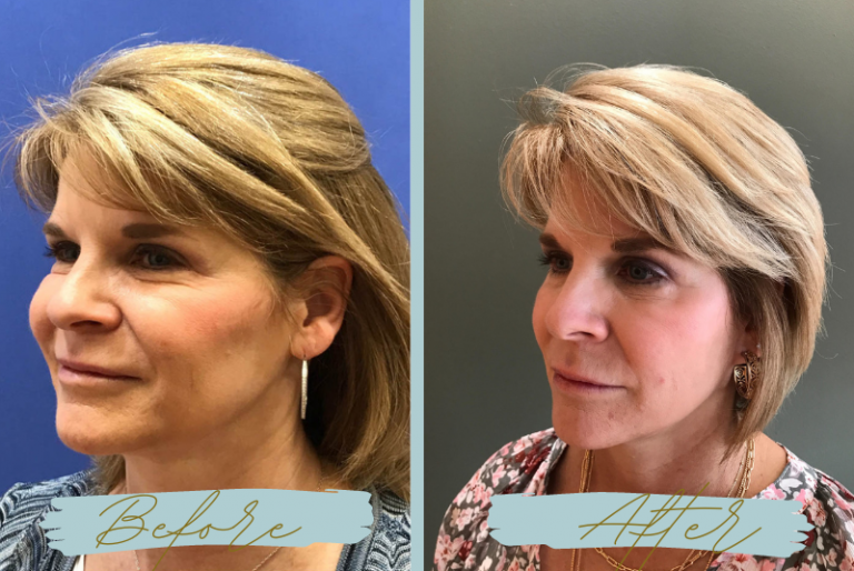 Two Facelift Approaches: Michelle’s Injectable Full Face Correction vs ...